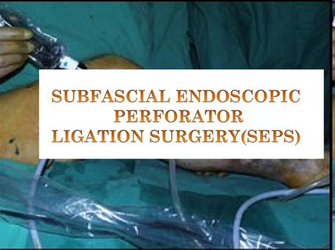 Varicose Vein Surgery Ppt