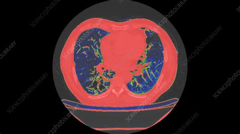 Bronchiectasis Ct Scan Stock Image F Science Photo Library