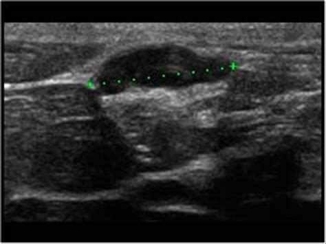 Breast And Axilla 5 1 Benign Lesions Case 5 1 8 Other Benign Non Cystic Lesions Ultrasound