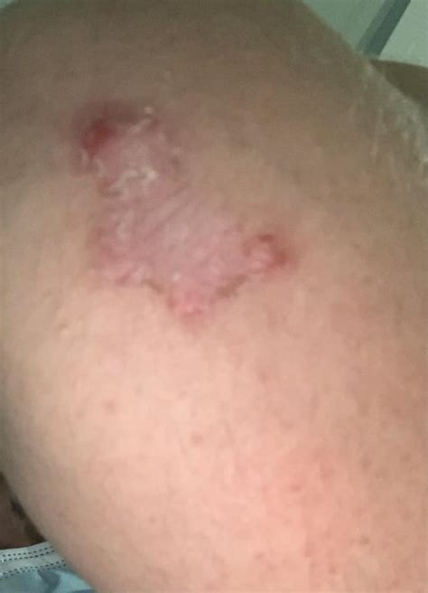 Is This Ring Worm Rmedical