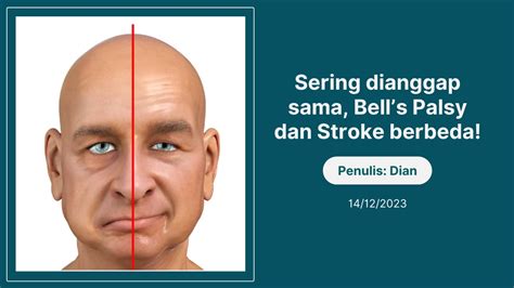 Sering Dianggap Sama Bells Palsy Dan Stroke Ternyata Beda