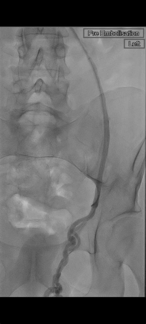 Embolisation Images And Flouroscopy Record R Varicocele