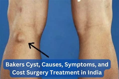 Synovial Cyst Causes And Treatment Diseases And Conditions 2025