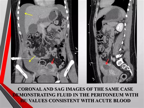 Ectopic Pregnancy Radiology Pptx