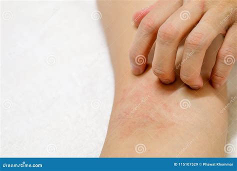 Red Rash In Between Fingers Dyshidrotic Eczema Symptoms Causes And