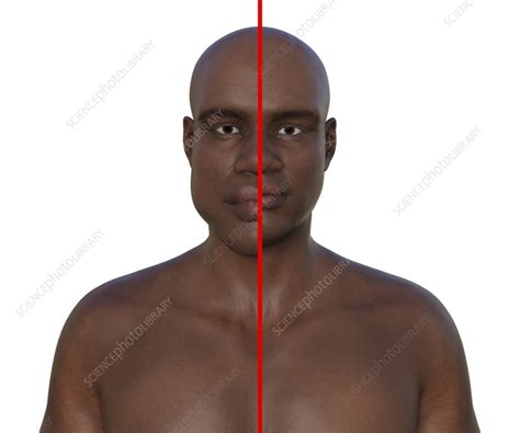 Man With Acromegaly Illustration Stock Image F042 6910 Science Photo Library