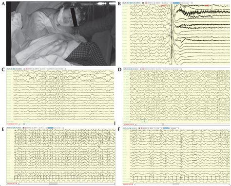 JLE Epileptic Disorders Clinical Evolution And Epilepsy Outcome In