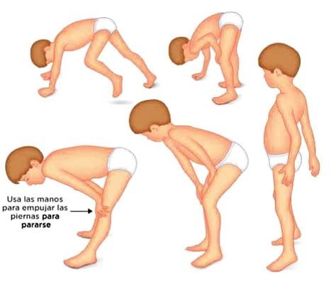 Distrofia muscular rompecabezas en línea