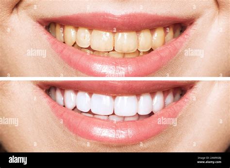 Woman Teeth Before And After Whitening Over White Background Dental