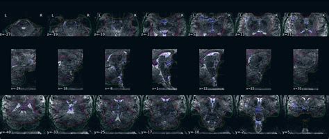 Can Fmriprep Handle Partial Brain Slabs For Functional Data Software