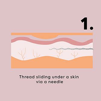 PDO Mono Threads Treatment SILK Laser Clinics