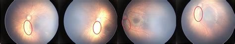 multiple fundus images from a examination with pre plus disease the