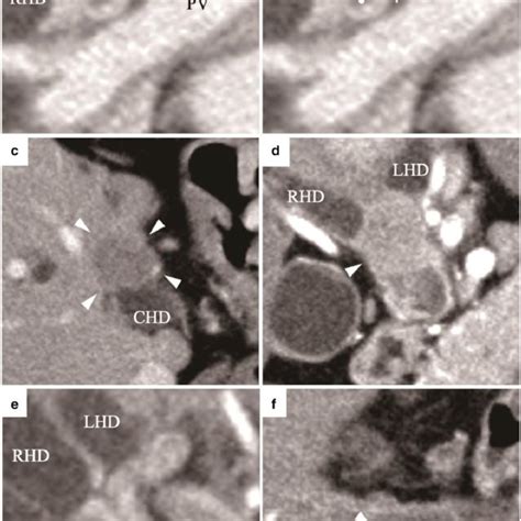 The Tumour Radiological Appearance On Multidetector Row Ct A The Download Scientific Diagram