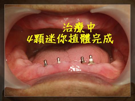 4顆迷你植體搭配活動假牙 成功案例 品橙牙醫診所 高雄植牙 高雄齒顎矯正