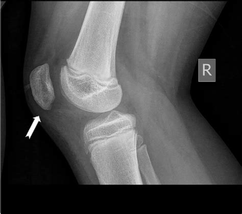 Figure 1 From Traction Apophysitis Of The Knee A Case Report
