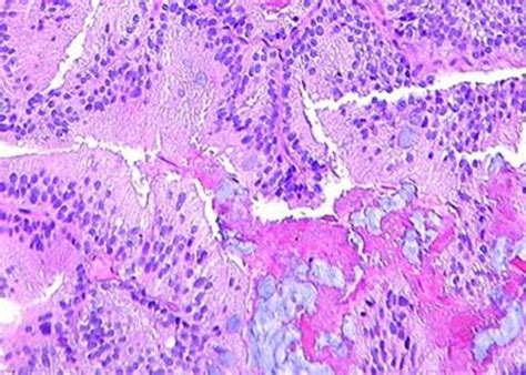 Patient Reported Functional Outcomes After Hypofractionated Or Conventionally Fractionated