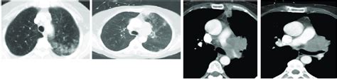 Ct Shows Two Spiculated Nodules In The Left Upper Lobe Lul Left