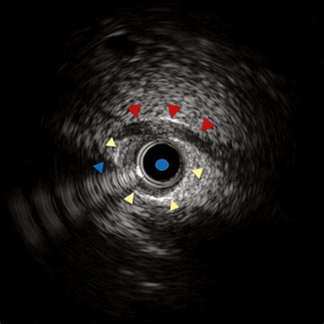 Intravascular Ultrasound Ivus Picture Of An Echo‐lucent Half‐moon Download Scientific Diagram