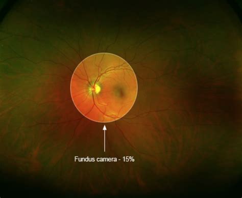 Oct Optomap Zeiss Iprofiler Richard Morwood Opticians Banbridge