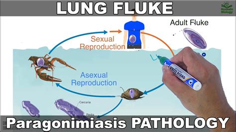Oriental Lung Fluke Causes Symptoms Treatment Oriental