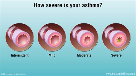 Diagnosing Asthma Mild Moderate And Severe