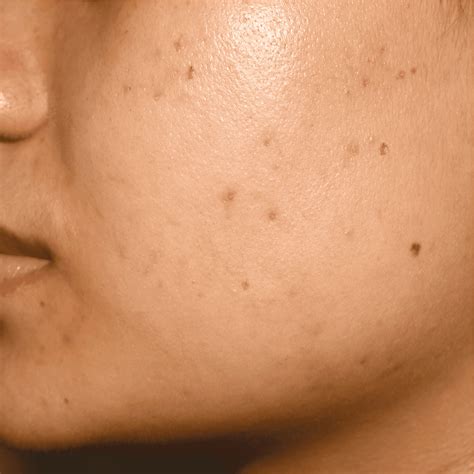 Hyperpigmentation Acne