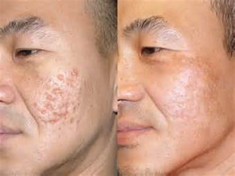 Acne Scars In Highland And New Paltz Essence Medispa Cosmetic Dermatology