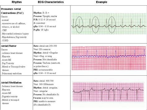 Printable Ekg Rhythms Printable Word Searches