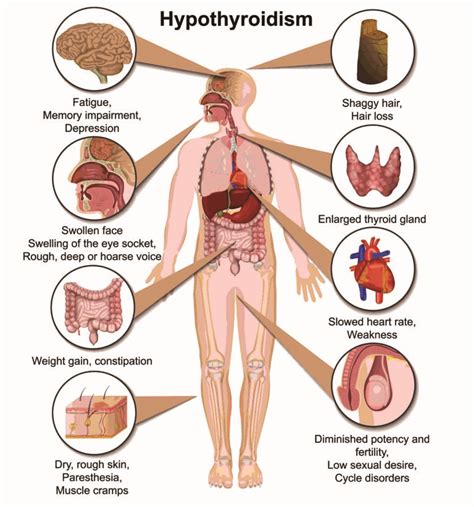 Hypothyroidism Underactive Thyroid Symptoms Causes And Treatment