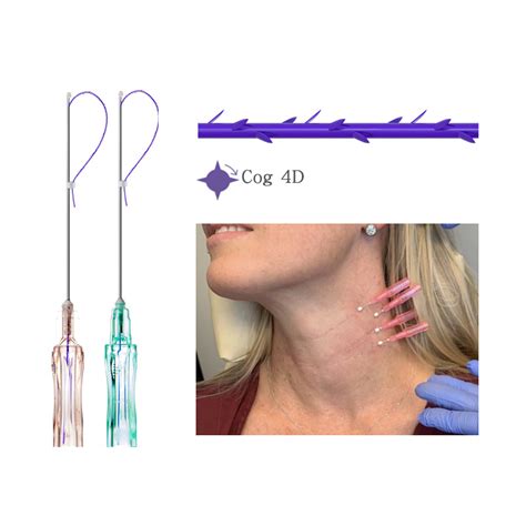 Deenora Smile Line Polydioxanone Suture Pdo Thread Cog 4d For Facial