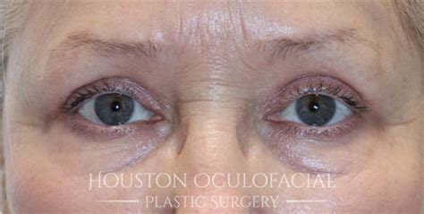 Houston Ptosis Droopy Eyelid Repair Before And After Photos Baytown