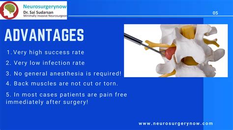 Endoscopic Lumbar Discectomy Ppt