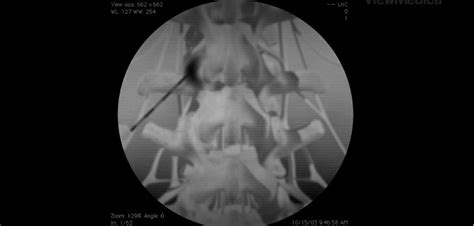 Facet Joint Injections Relieve Back Pain Effectively