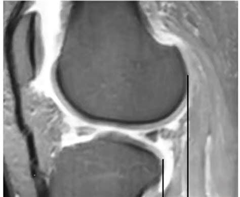 前交叉韧带（acl）影像解剖、损伤机制、mr诊断、分级以及直接与间接征象 知乎