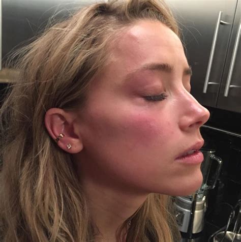 Photo Shows Amber Heards Face After Johnny Depp Threw Phone Daily