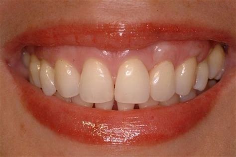 Pin On Root Coverage With Tunneling Technique In A Gummy Smile Case By Dott Roberto Rossi
