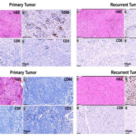 Immune Partial Proteomic Profiling In Primary And Recurrent Paired Download Scientific Diagram