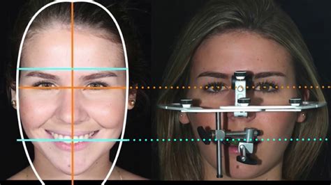 Arco Facial Para Montagem De Plano Oclusal Superior E Sua Importância