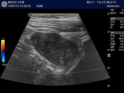 Vietnamese Medic Ultrasound Case 267pelvic Mass And Melena Dr Phan