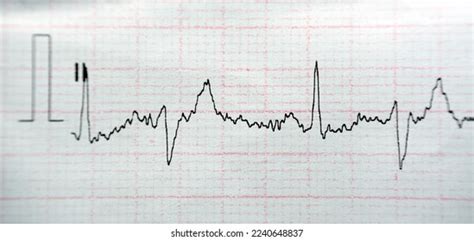 Premature Ventricular Complex