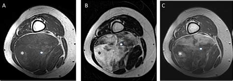 Liposarcoma Mixoide Características Por Resonancia Magnética Con Correlación Histológica
