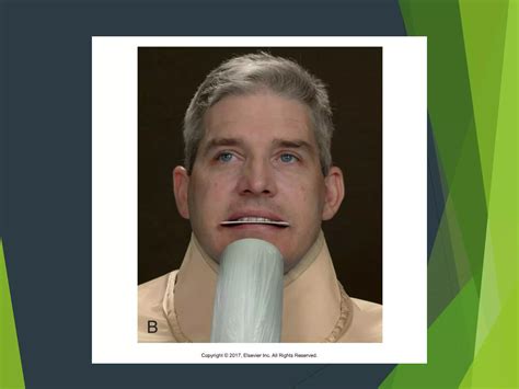 Chapter 21 Occlusal And Localization Technique Ppt