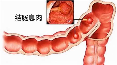 腸息肉不是切掉就一勞永逸，多久複查一次？ 每日頭條