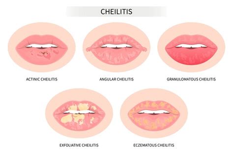 Blisters On Lips Allergic Reaction