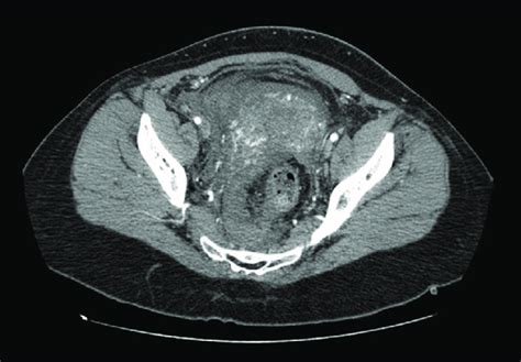 Case 1 Abdominal And Pelvic Computed Tomography Angiography With