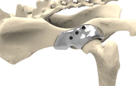 3d Hip Rita Leibinger