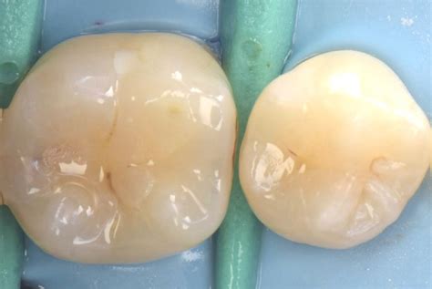 Icon Proximal Use In Early Enamel Lesions