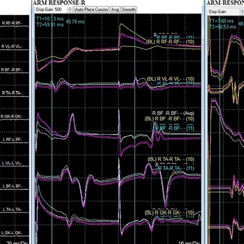 Intraoperative Monitoring Screen Is Shown For Recordings As Follows