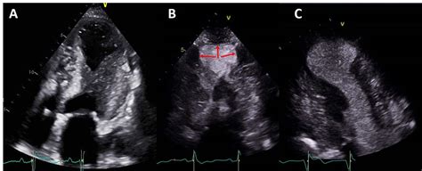 Hypertrophic Cardiomyopathy With Mid Cavitary Obstruction And Apical