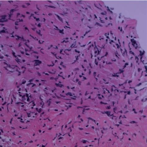 Right Retrocaval Lymph Node Biopsy Showing Granulomatous Formation And Download Scientific